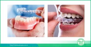 Niềng răng invisalign sử dụng khay Invisalign và phần mềm 3D