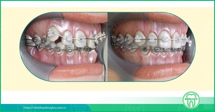 Loop đóng khoảng răng cửa là gì? Giai đoạn này mất bao lâu?