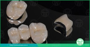 Răng sứ Titan là gì? Quy trình bọc sứ Titan như thế nào?