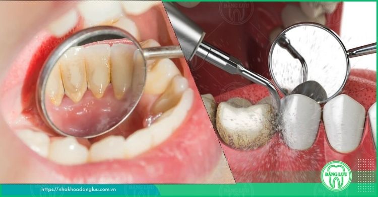 Vôi răng tự tróc tự rơi ra có tốt không?