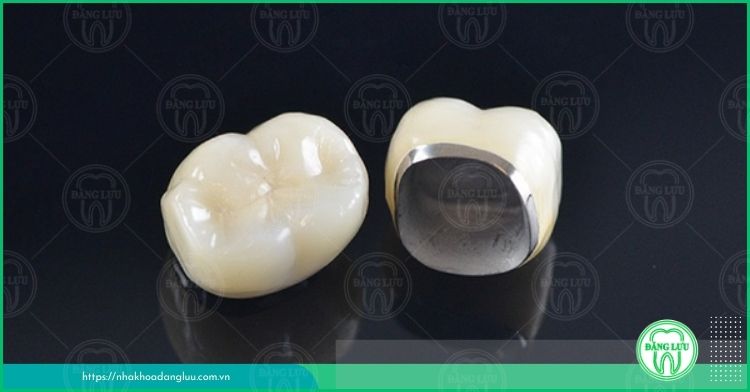 Trồng răng sứ Titan như thế nào? Tiến trình thực hiện