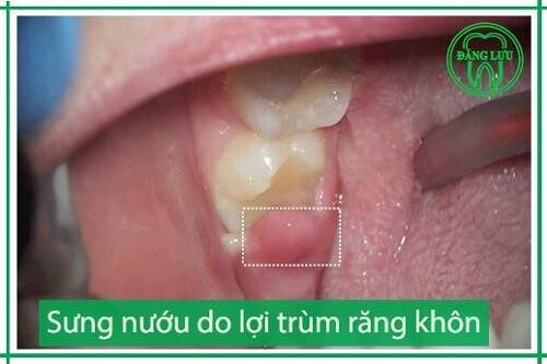 Sưng nướu răng trong cùng điều trị như thế nào hiệu quả?